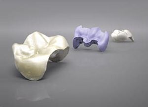 Kronen und Brücken » Wann ist welcher Zahnersatz geeignet?