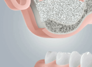 Parodontalchirurgie » Zahnfleischbehandlung bei schwerer Parodontose